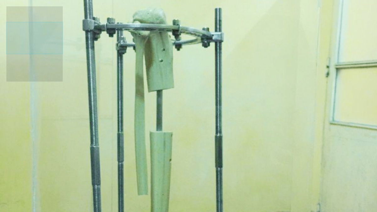 Men are travelling to Turkey to have their leg bones deliberately ...